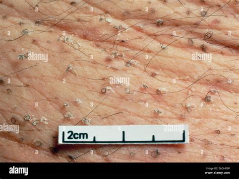 Corkscrew Hairs On The Skin Of A Patient Suffering From Scurvy A