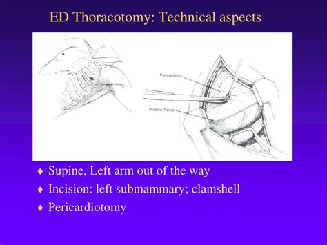 Clamshell Thoracotomy