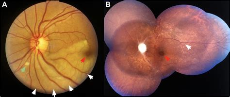From Heart To Eye Central Retinal Artery Occlusion Secondary To