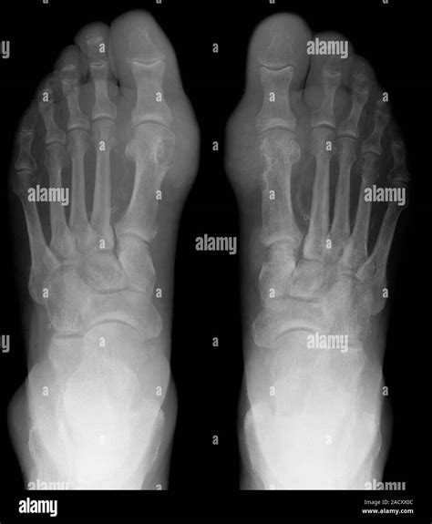 X Ray Of The Feet Of A Patient With Gout Gout Is A Disorder Of Uric