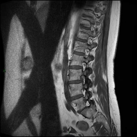 Disc Herniation Mri