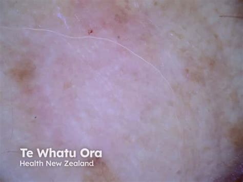 Basal Cell Carcinoma Dermoscopy