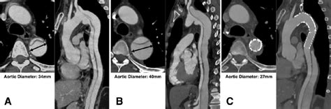 Successful Preemptive Tevar In A Patient With Uncomplicated Tbad A