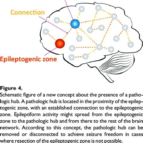 Pdf Identifying The Epileptogenic Zone In Interictal Resting State Meg Source Space Networks