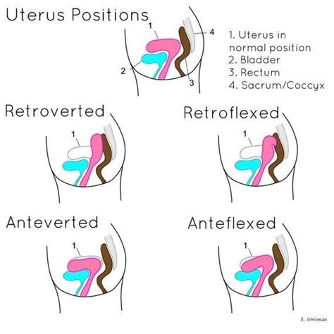 Retroverted Uterus Exercises