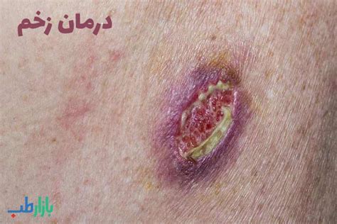 درمان انواع زخم بازارطب