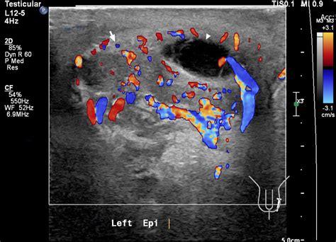 Acute Epididymitis Related Global Testicular Infarction Eurorad