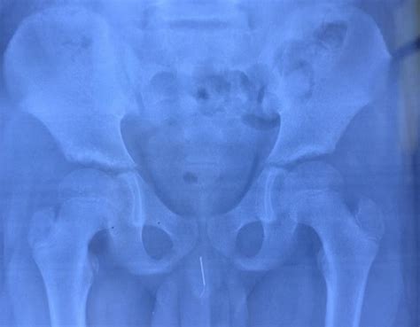 Painful Discovery On X Ray Of 11 Year Olds Penis
