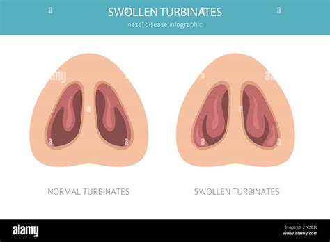 Inflamed Nasal Turbinates