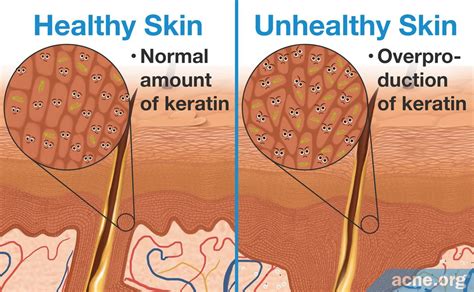 The Role Of Skin Cell Overgrowth Hyperkeratinization In Acne