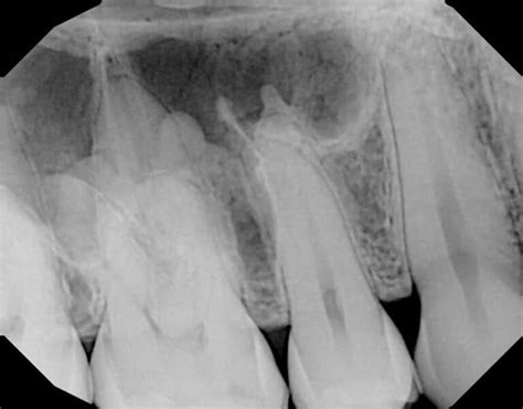 Periapical And Bitewing Radiopacities Radiodontics