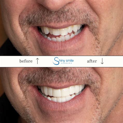 Snap On Veneers By Shiny Smile Veneers Shiny Smile Veneers