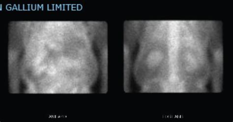 What Is A Gallium Scan Test At Trudi Abbas Blog