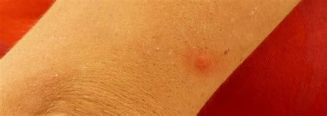 Common House Spider Bites Identification And How To Treat