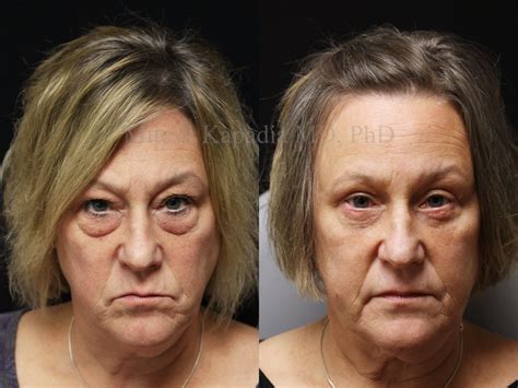 Before And Four Weeks After After Upper And Lower Blepharoplasty