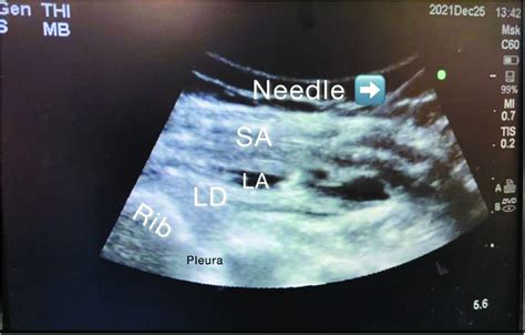 Ultrasound Guided Serratus Anterior Block Sapb Identifying The