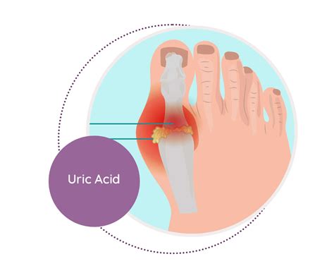 Uric Acid Mediscan Lab