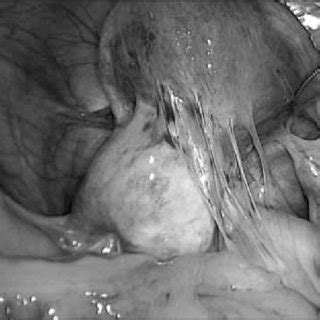 Genital Organs Prior To Dissection Multiple Adhesions Between The Left Download Scientific