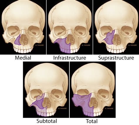 Maxilla Anatomy