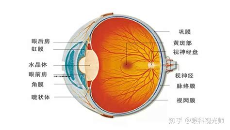 高度近视患者为什么会并发眼底黄斑病变 知乎