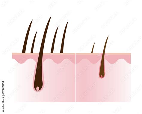 Comparison Of Healthy And Losing Hair With Scalp Layer Vector Isolated On White Background Hair