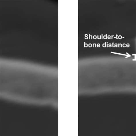 Pdf Clinical Testing Of An Alternate Method Of Inserting Bone