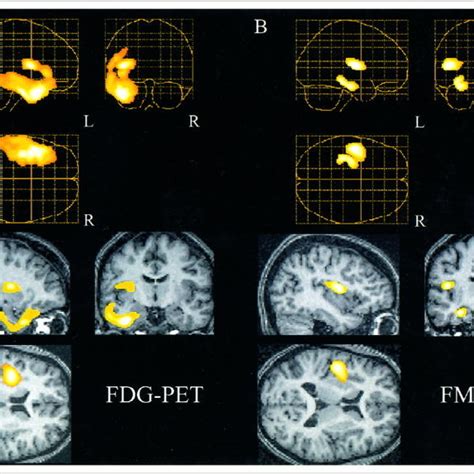 Group Analysis In Statistical Parametric Mapping Spm P