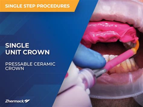 Zhermack Dental Clinical Procedure For Complete Removable Prosthesis