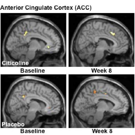 Multi Source Interference Test Msit Percent Improvement Of