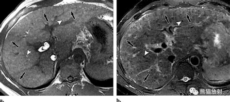 肝纤维化丨mr成像方法及表现 Medscicn
