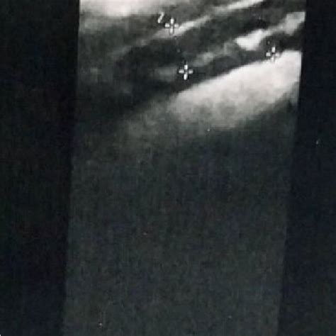 Intraoperative View Showing Appendicular Mass Download Scientific Diagram