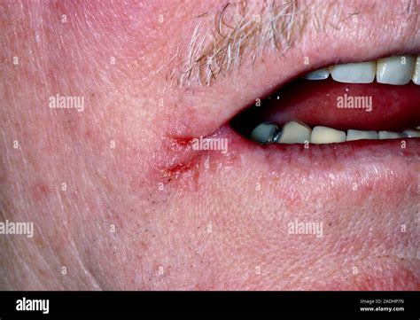 Angular Stomatitis Cracking And Splitting Of Tissues At The Junction Of