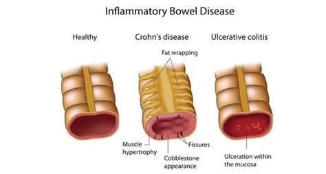 What Is Indeterminate Colitis Ibd Relief