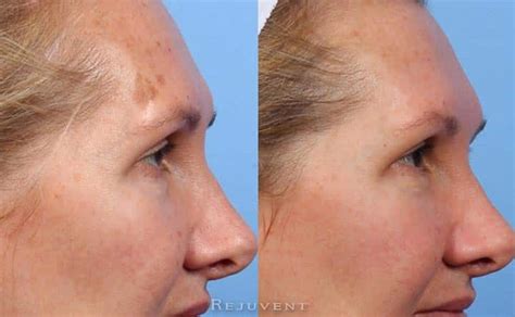 Lesion Excision • Rejuvent Medical Spa Scottsdale