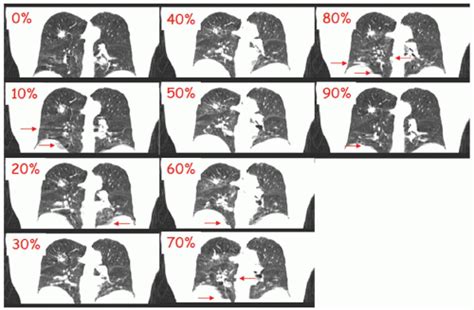 Management Of Respiratory Motion In Radiation Therapy Radiology Key