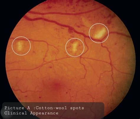 🟢exudates Vs Cotton Wool Spots 🔴cotton Wool Spots Are Composed Of Themba Madlala