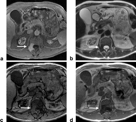 Mri Diagnosis Of Brown Tumor Based On Magnetic Susceptibility Knowles