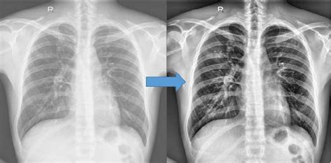 X Ray Adaptive Histogram Equalization Download Scientific Diagram