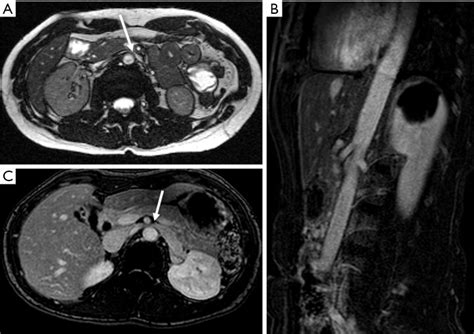 Nutcracker Syndrome Diagnosis And Therapy Pmc