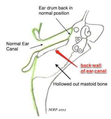 Treatment For Cholesteatoma Ears And Hearing Uk