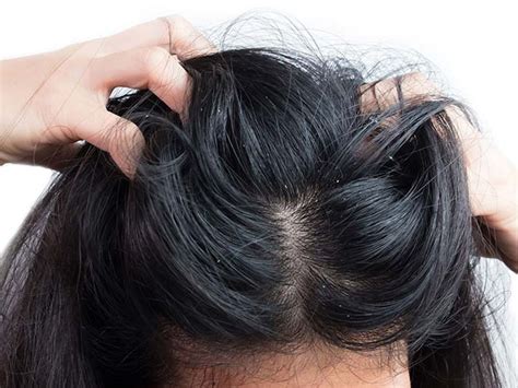 Fleas In Human Hair Symptoms And How To Stop This Menace