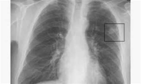Ai Model May Improve Pulmonary Nodule Detection On Chest Radiograph Jama