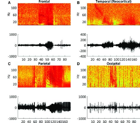 Examples Of Seizure By Lobe Of Onset These Examples Of Electrographic Download Scientific
