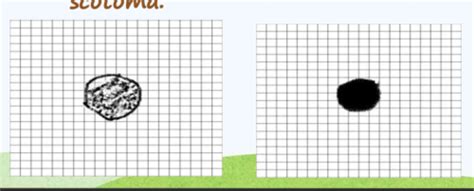 Amsler Grid And Colour Vision Charts Flashcards Quizlet