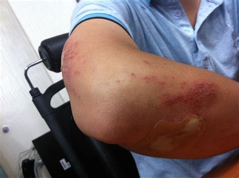 What Is A Contusion Klarity Health Library
