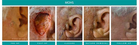 Mohs Surgery Derick Dermatology