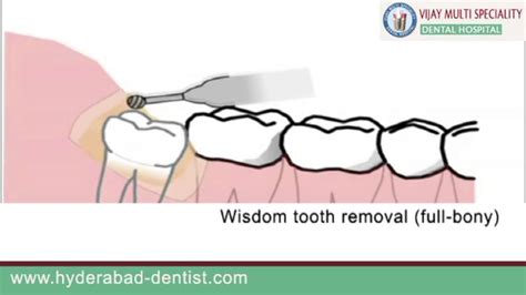 Full Bony Impacted Wisdom Teeth Code