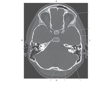 Axial Ct Lambdoidal Suture Quiz