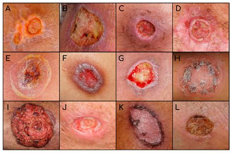 Examples Of Other Types Of Skin Lesions A Ecthyma B Erysipelas