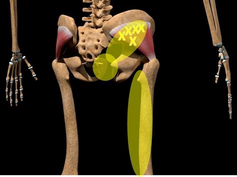 Gluteus Minimus Trigger Point